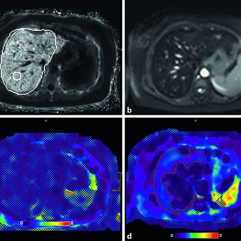The Interpretation Of Te Or Fibroscan Results By Kilopascal And The