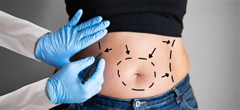 Managing Liposuction Scars Prevention And Treatment Tips