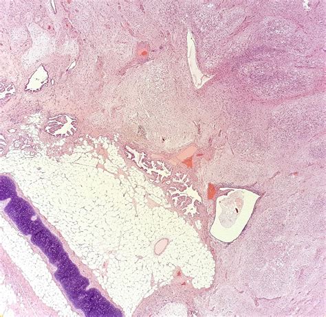 Pathology Outlines Teratoma Immature