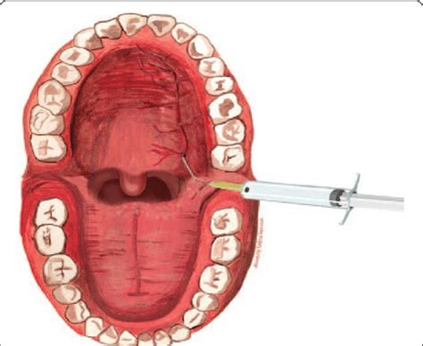 Pterygopalatine Fossa Injection Trans Oral [6] Download Scientific Diagram