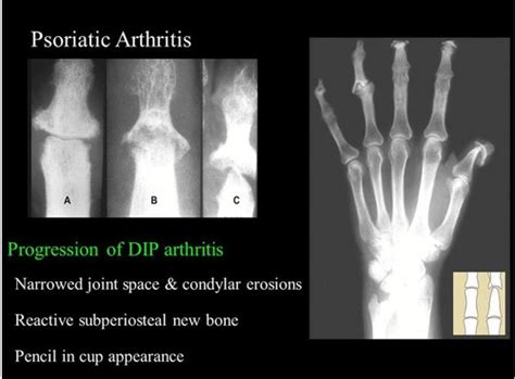 Psoriatic Arthritis Pencil In Cup