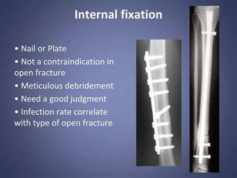 open fracture pptx