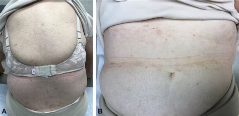 Patient 7 2 Weeks After Initiating Valacyclovir Therapy 3 Weeks Total Download Scientific