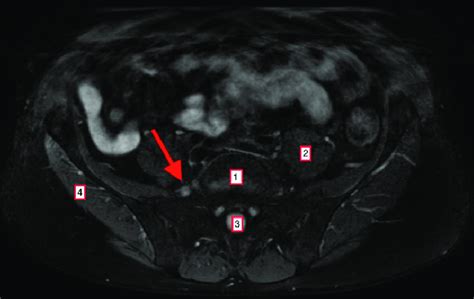 Contrast Enhanced Axial Mri Demonstrating Enhancement Of The Right L5