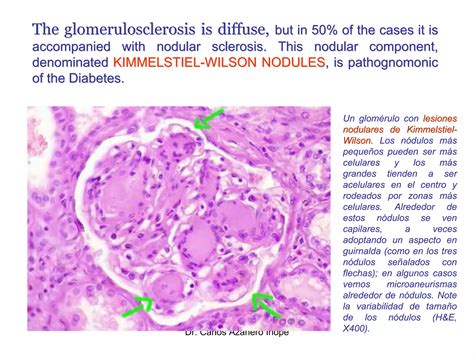 Pathophysiology Of Diabetic Nephropathy Pdf