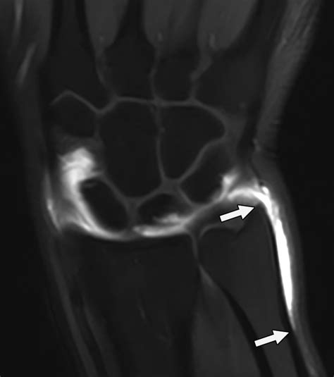 Ulnar Collateral Ligament Wrist Mri