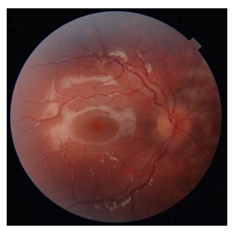Examples Of Hess Charts Showing Ocular Motility Misalignment In Sop