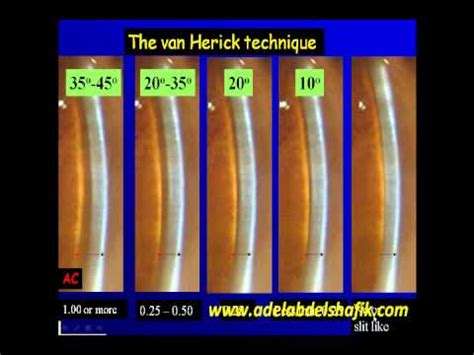 Van Herick Technique •