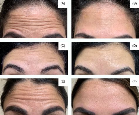 Improvement Of Dynamic Forehead Wrinkles Following Injection Of