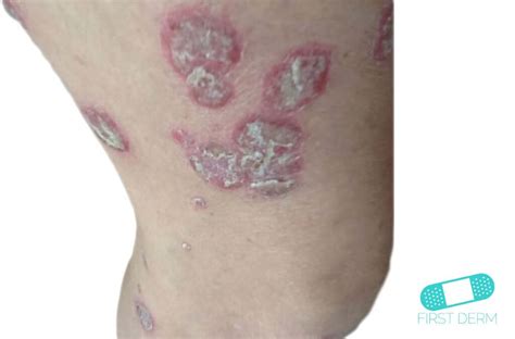Psoriasis Hudläkare På Nätet First Derm