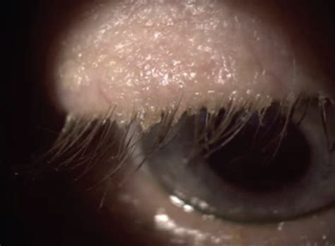 Demodex Friend Or Foe