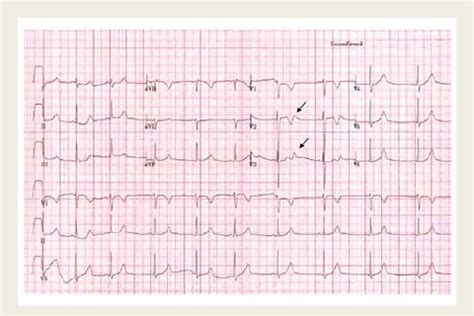 Baseline Electrocardiogram Demonstrating A Qtc Of 470 Arrows Depict