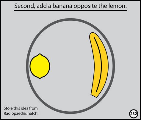 Subdural Hematoma Vs Epidural Hematoma