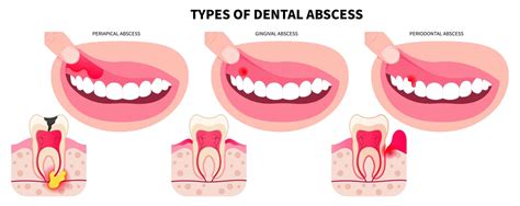 Tooth Abscess Types Infoupdate Org