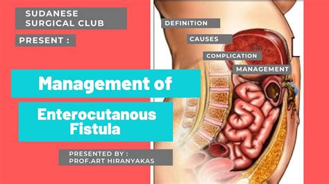 Management Of Enterocutaneous Fistula Youtube