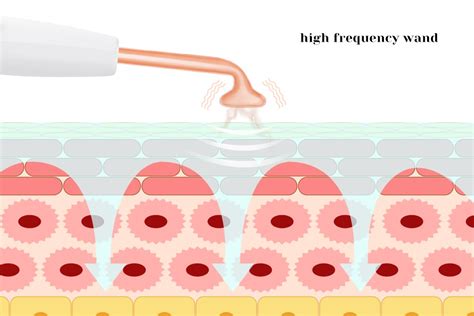 High Frequency Electrotherapy Facial Skin Beauty Device Konmison