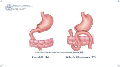 Physiologic Vs Non Physiologicanastomosis After Subtotal Gastrectomies For Gastric Cancer Ppt