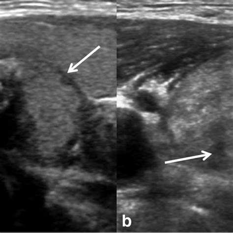Thyroid Nodules With Heterogeneous Echotexture A Nodule With
