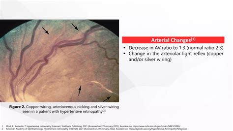 Hypertensive Retinopathy 2pptx
