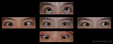 Localized Orbital Amyloidosis Presenting As New Onset Diplopia