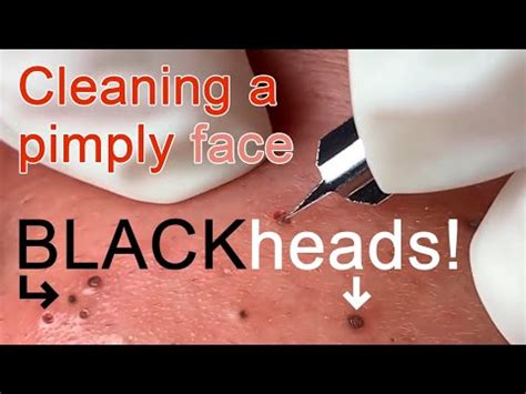 Blackhead Extraction Cleaning A Pimply Skin YouTube
