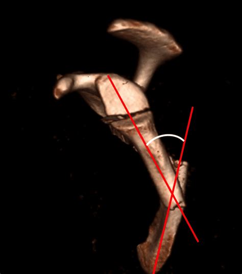 The Armdoc Scapula Body And Glenoid Fossa Fractures