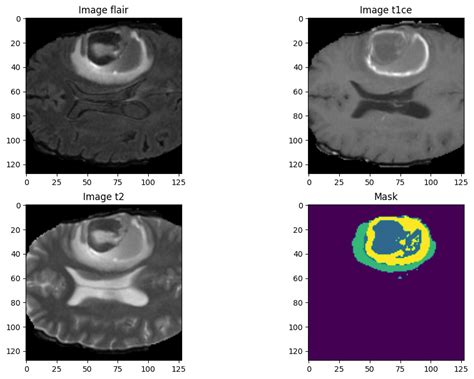 Github Theodoremanuelsson D Braintumor Segmentation D Unet Model Of Brain Tumor Segmentation