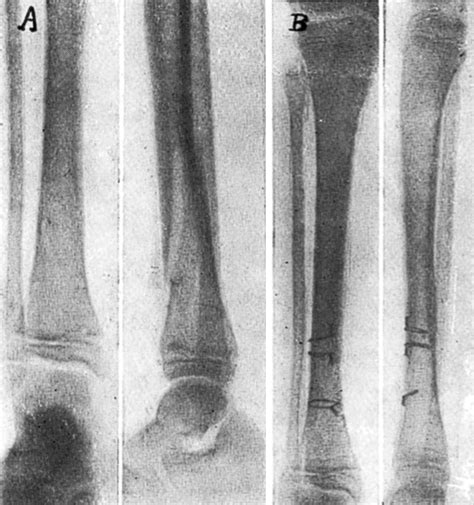Fractura Espiral De Tibia Y Peroné