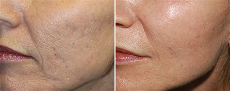 Micro Needling Treatment In Waterloo On Revive Cosmetics Clinic