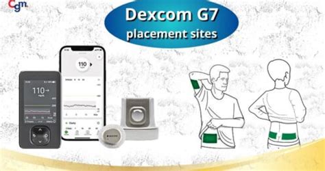 Dexcom G Sensor Failure What Should We Do About It