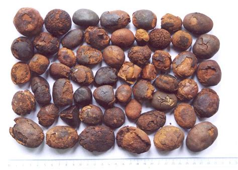 Gallstones