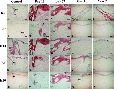 Hyperproliferation K6 And K16 Basal Epidermal K14 And