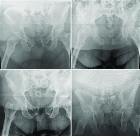 Radiographic Images That Show A 55 Mm Pubic Symphysis Diastasis And Download Scientific