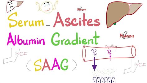 Serum Ascites Albumin Gradient Saag Peritoneal Effusion Lab 🧪