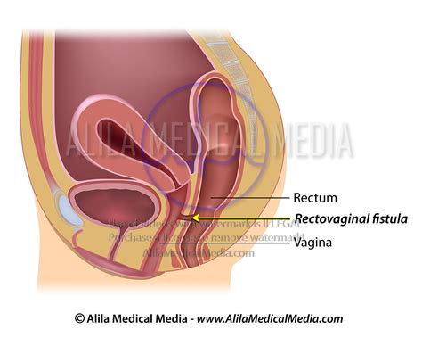 Rectovaginal Fistula