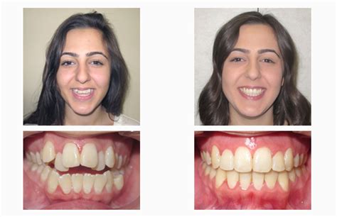 Self Ligating Braces What Are They Benefits And Costs