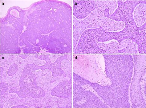 Basaloid Squamous Cell Carcinoma Hande A Tumor Lobules Pattern × 40 Download Scientific