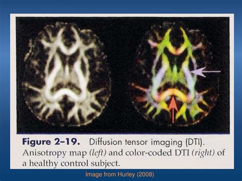PPT D Iffusion Tensor Imaging In Mild Traumatic Brain Injury