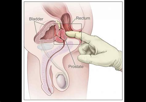 Kanker Prostat Penyebab Gejala Perawatan Pencegahan Obat