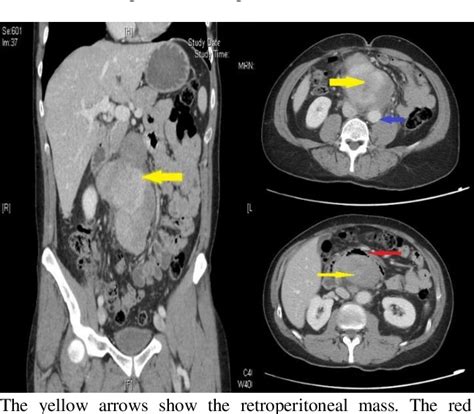 Figure 1 From What Do We Know About Intravascular Fasciitis Affecting Inferior Vena Cava
