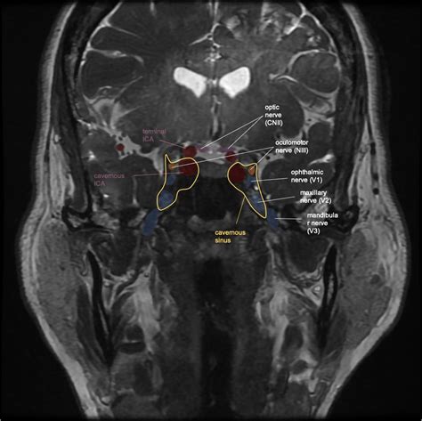 Cavernous Sinus Mri Labeled