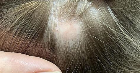 Patch Album On Imgur Patch Album On Imgur