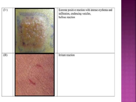 Patch Test In Dermatology Pptx