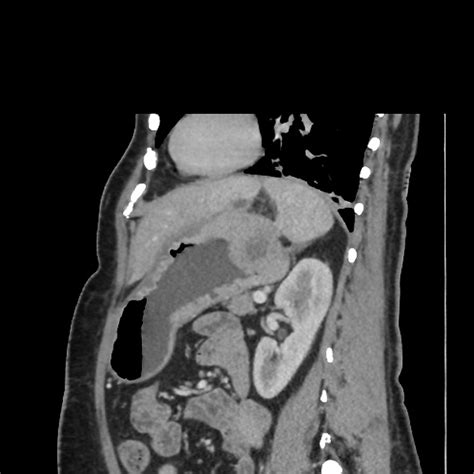 Gastric Gastrointestinal Stromal Tumors Pacs