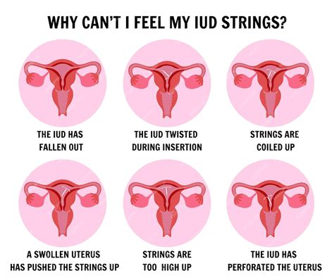 Premium Vector Causes Not Feel Iud Strings Intrauterine Device In Vector