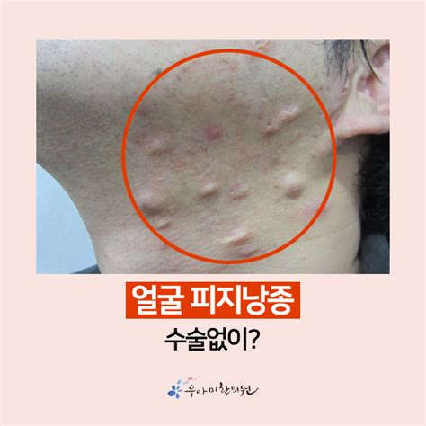 턱 종기 피지낭종 염증이 있어도 제거 가능한가요 네이버 블로그