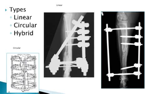 Exam I External Skeletal Fixation Flashcards Quizlet