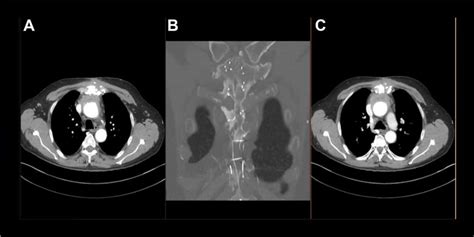 Preoperative Thoracic Ct Scan A Image Indicates The Sternal Defect Download Scientific