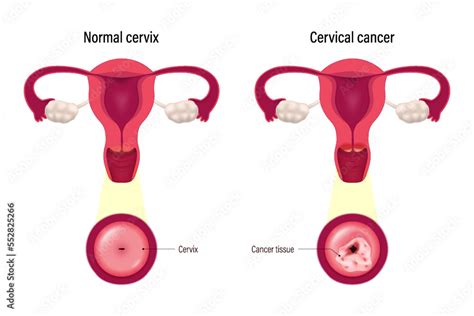 Comparison Of Normal Cervix And Cervical Cancer Cervix Carcinoma Female Reproductive System