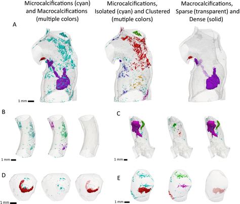 [pdf] Phenotyping Calcification In Vascular Tissues Using Artificial